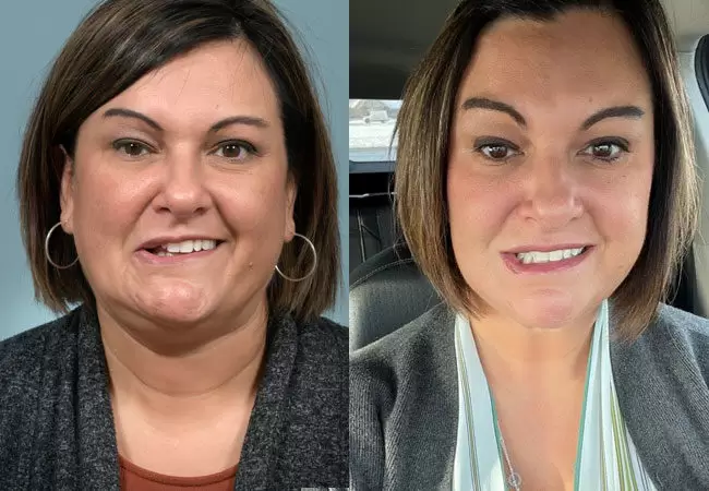 فلج بلز : علت، علائم، تشخیص و درمان - پروفسور محمد طاهر رجبی